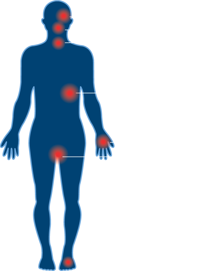 HAE Symptoms - Icatibant Injection from Fresenius Kabi